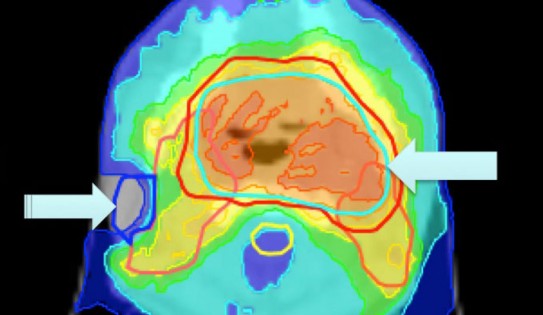 Study to reduce radiotherapy toxicity | Department of Engineering